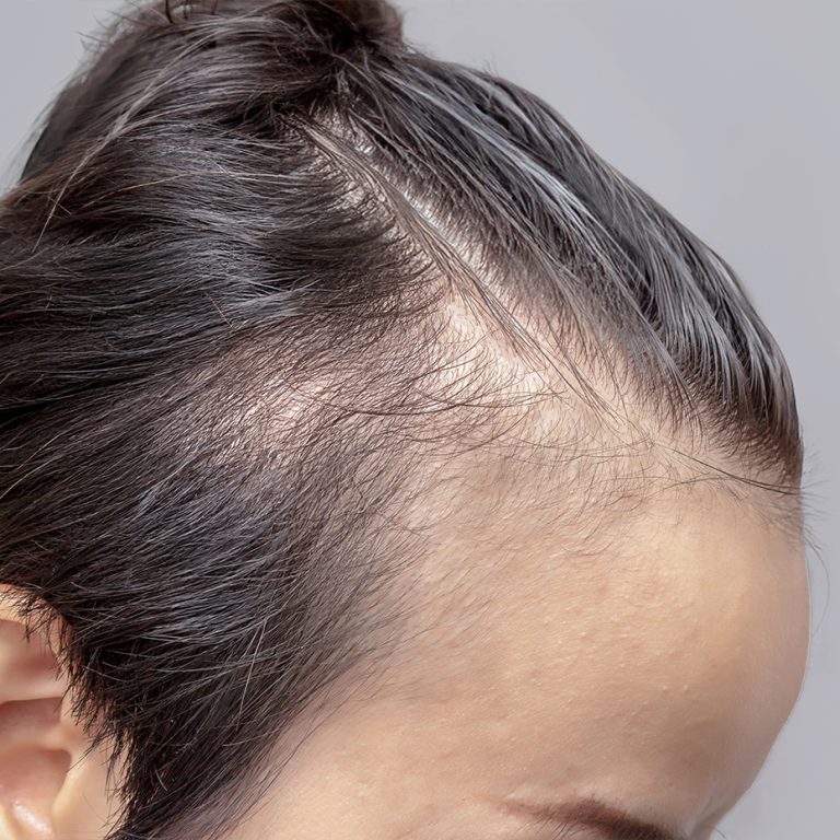 Hair Loss Treatment in Singapore | DrScalp