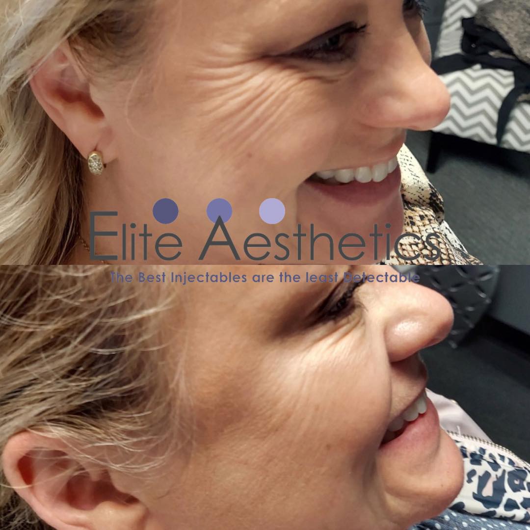 Skin Tightening Overland Park Kansas