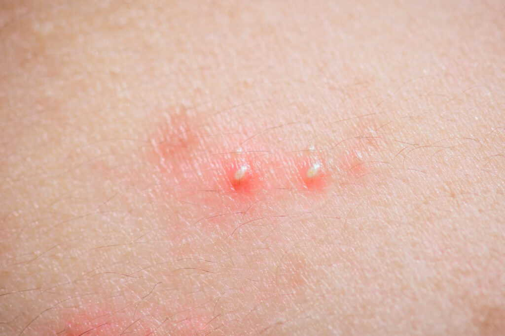 How to Get Rid of Back Acne for Smooth Skin