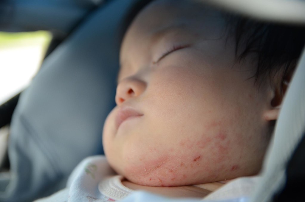 Penyebab Kulit Bayi Jadi Merah dan Cara Mengatasinya